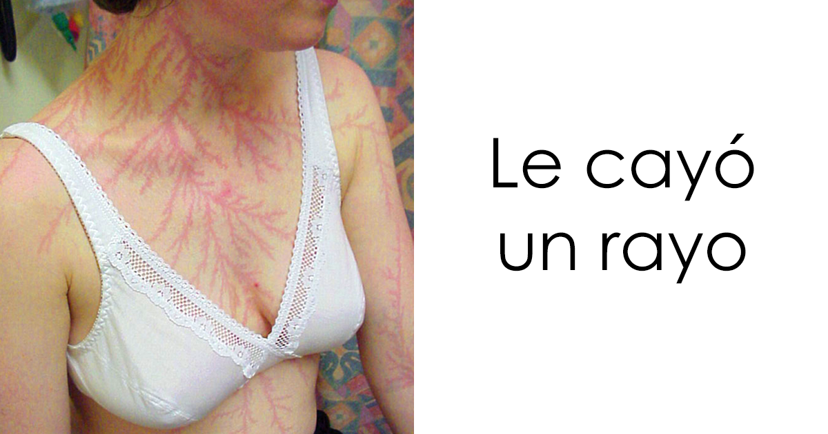 19 Personas que sobrevivieron tras caerles un rayo muestran lo que causa en tu piel | Panda Curioso